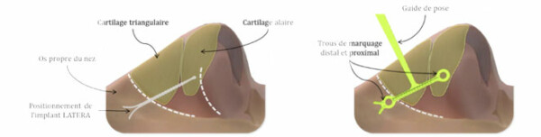 Implant Latéra : réduction de l’obstruction nasale | Dr. Stéphane ...